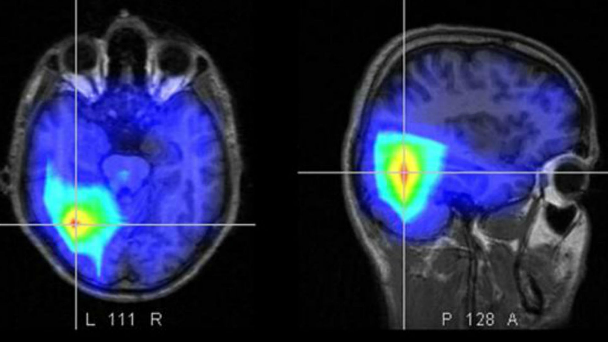 ACV: lo que tenemos que saber • Penta - Medicina Cardiovascular